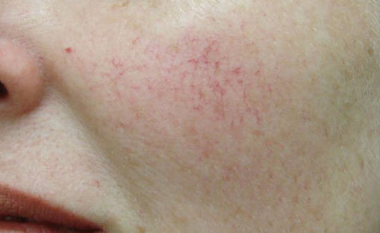 Broken Capillaries — Atone Skin Clinic
