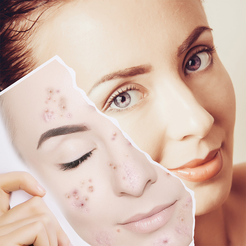 Papules & Pustules (Active Breakouts) — Atone Skin Clinic