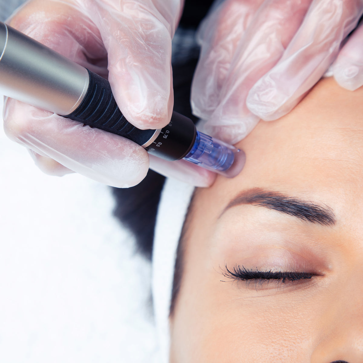 2 x Astra Pen + Led Skin Needling, Collagen Induction | Atone Skin Clinic